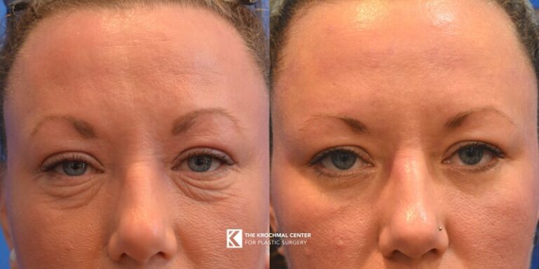 Photo Gallery: Chicago Eyelid Surgery | Krochmal Plastic Surgery